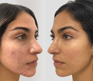 Severe Nodular Acne Treatment | ABSORICA LD® (isotretinoin)
